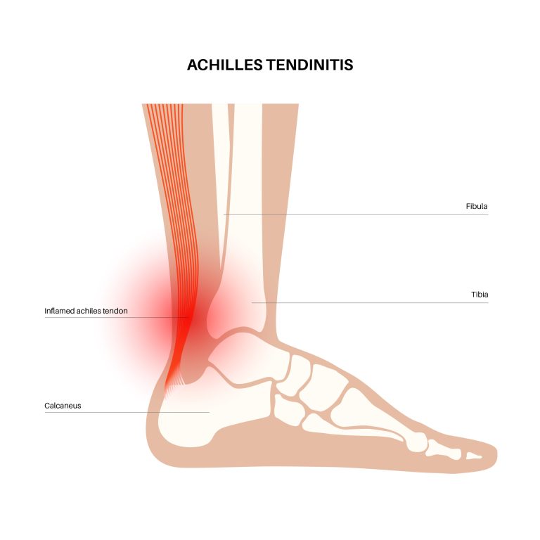 Achilles Tendinopathy