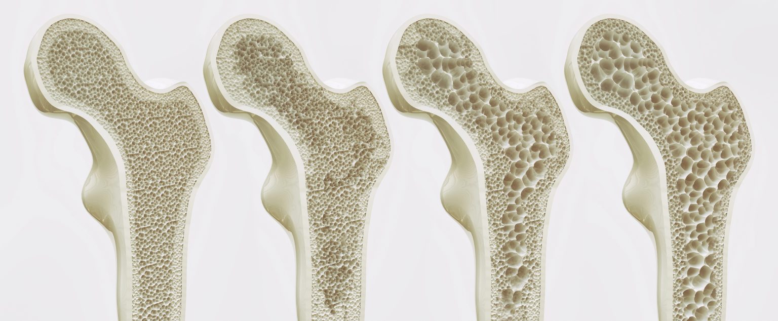 Stronger Bones, Healthier Life: How Exercise Fights Osteoporosis